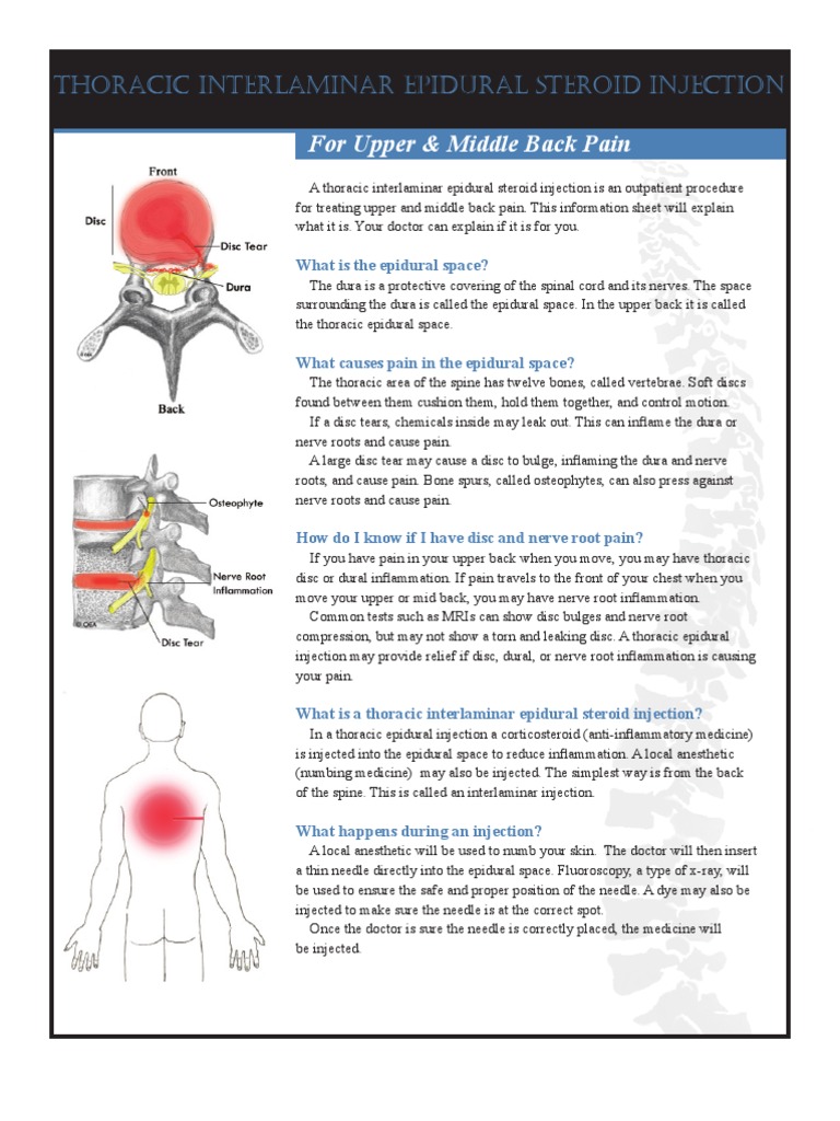 Thoracic Epidural Steroid Injection | PDF | Back Pain | Injection ...
