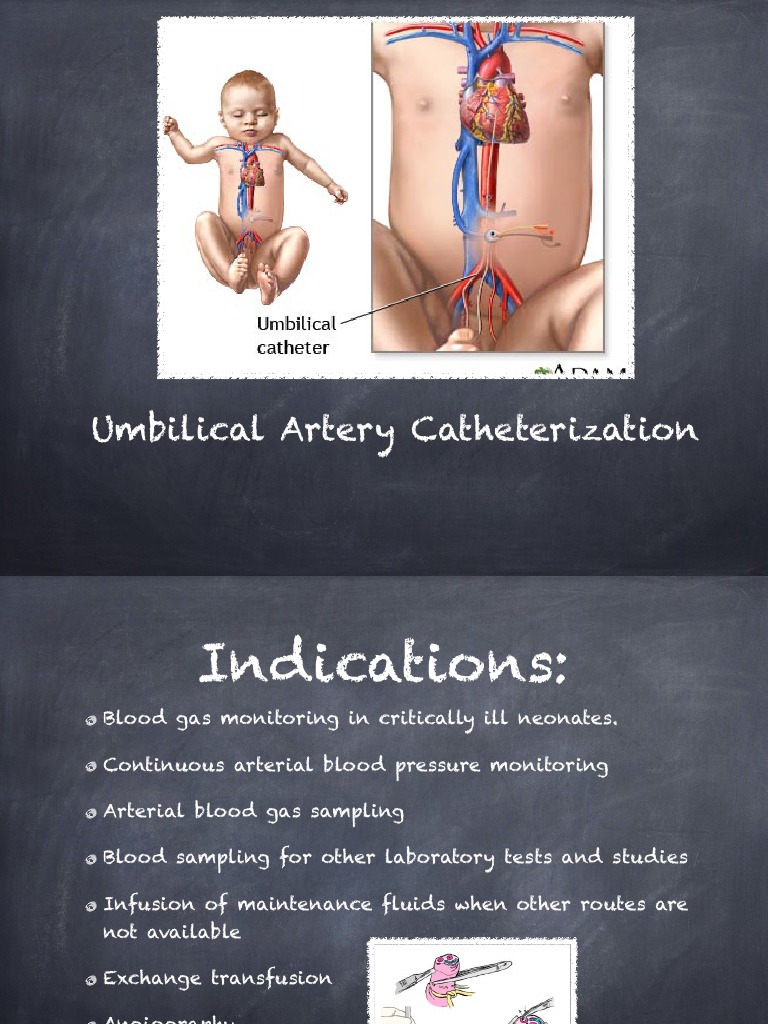Umbilical Artery Catheterization: A Comprehensive Guide to Indications, Procedure, Positioning ...