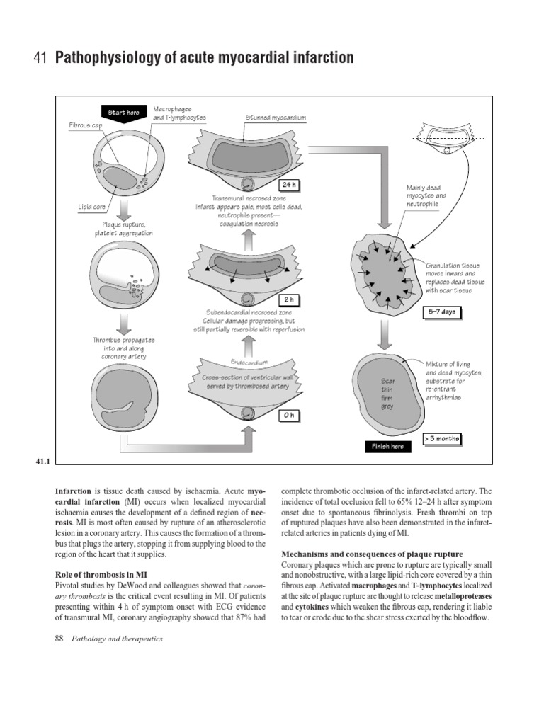 Pathophysiology of Myocardial Infarction | PDF | Myocardial Infarction ...