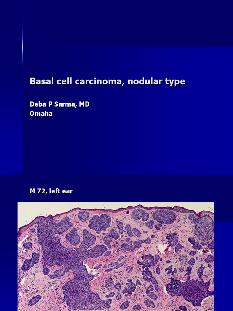 Basal Cell Carcinoma, Nodular Type, M 72, Left Ear. | PDF