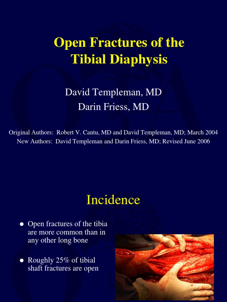 Open Fractures of The Tibial Diaphysis: David Templeman, MD Darin ...