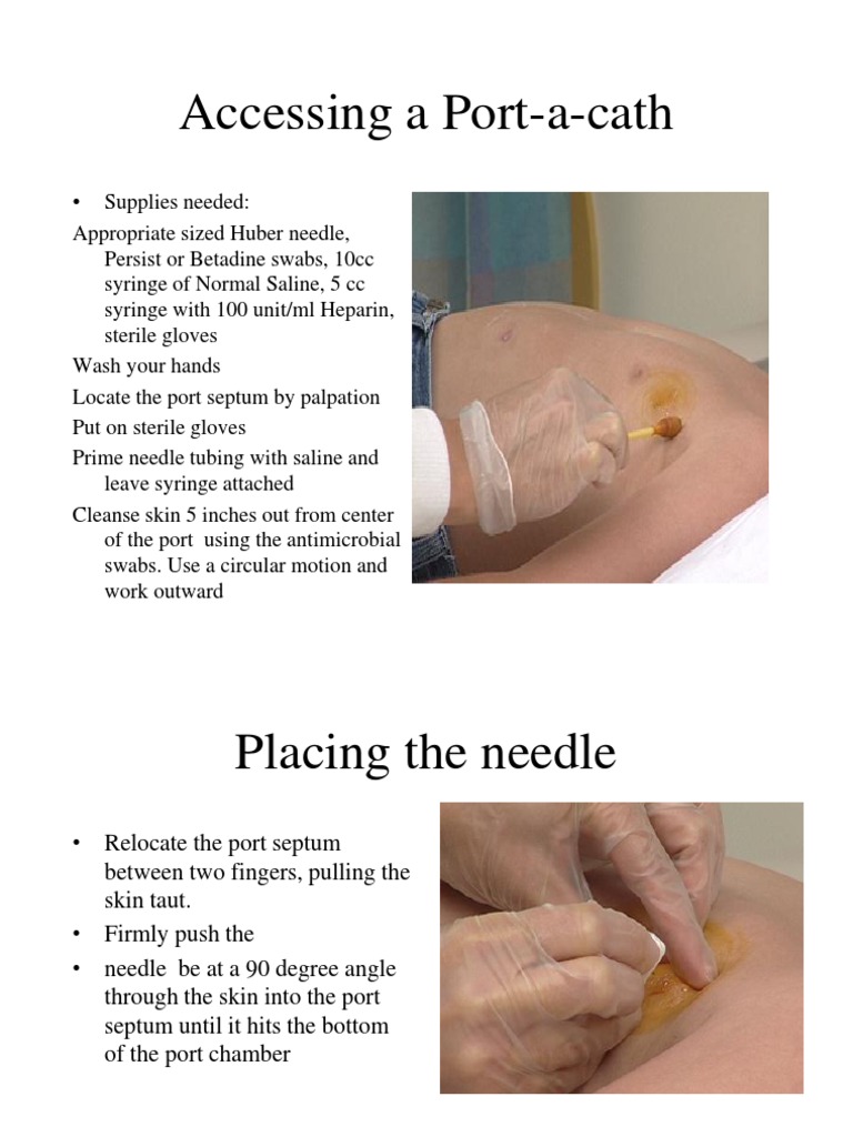 Access Portacath | PDF