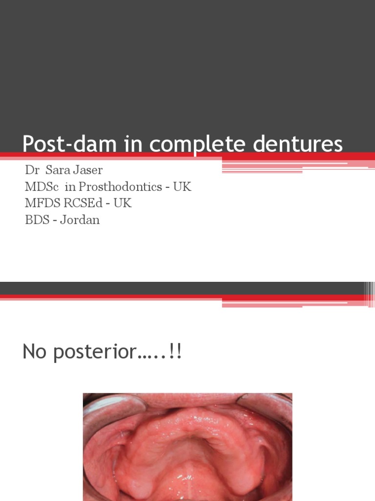 Post-Dam in Complete Dentures | PDF | Dentures | Nature