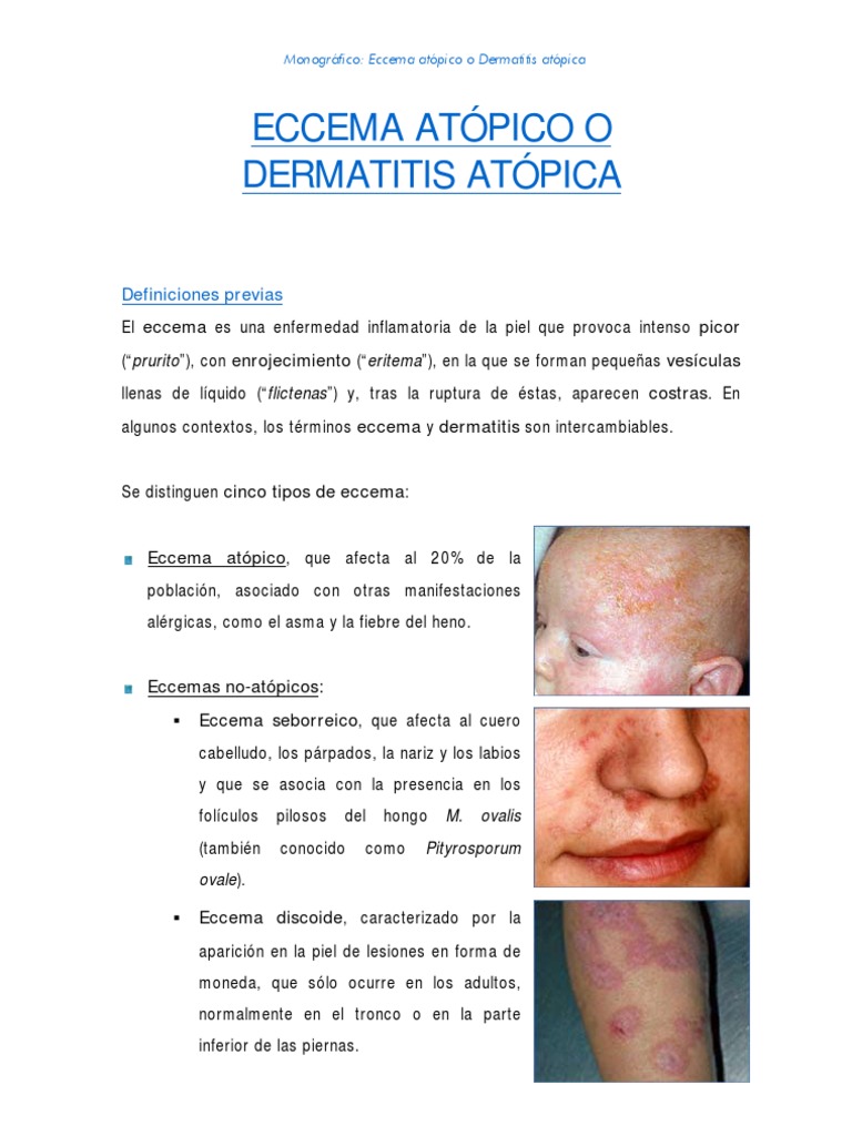 Eccema Atopico o Dermatitis Atopica | PDF | Alergia | Dolor