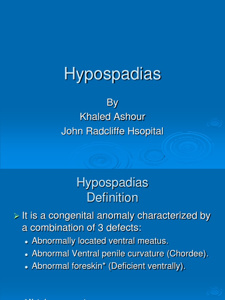 hypospadias | Genitourinary System | Reproductive System