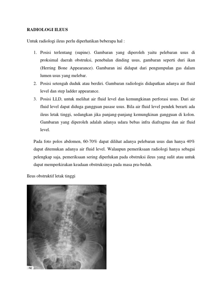 Radiologi Ileus | PDF