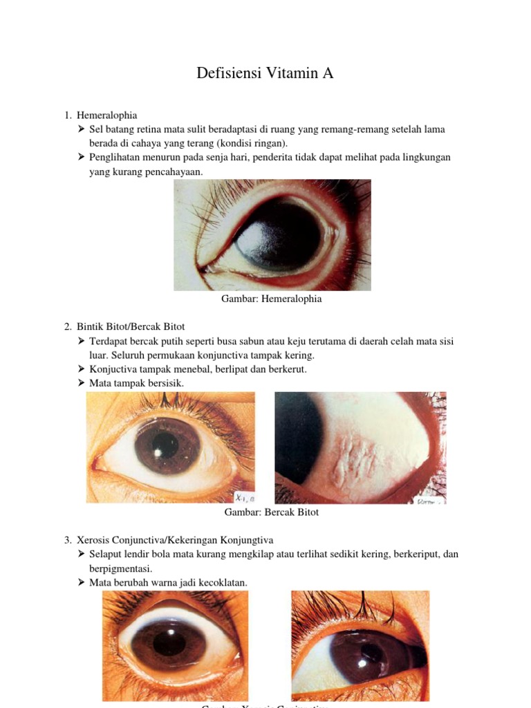 Defisiensi Vitamin A | PDF