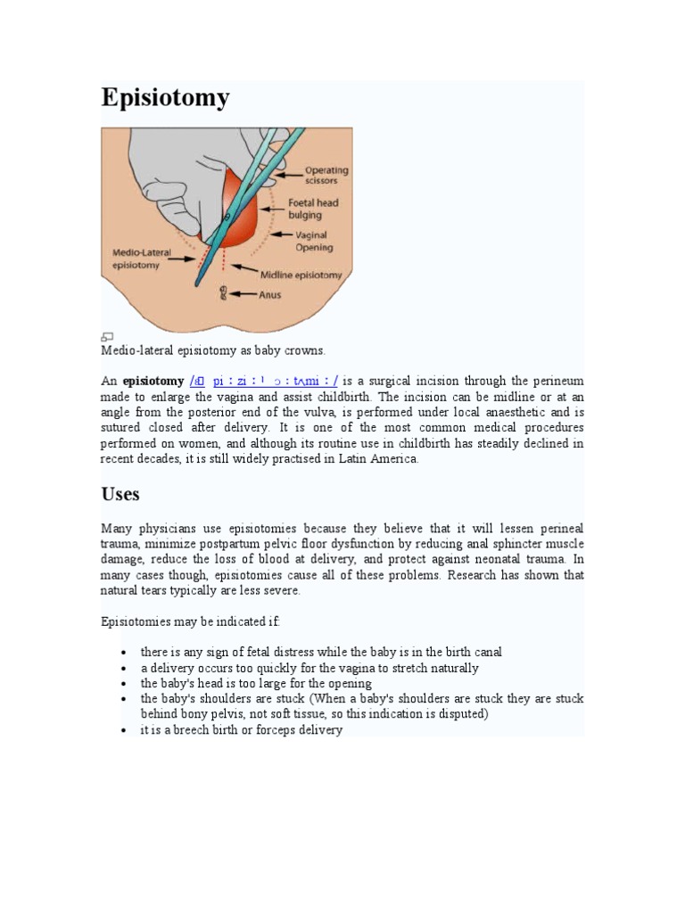Episiotomy | PDF | Childbirth | Women's Health