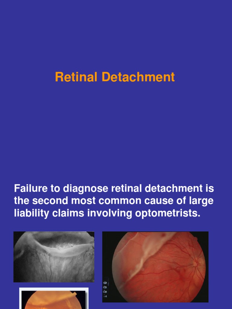 Ablasio Retina | PDF | Eye | Ophthalmology