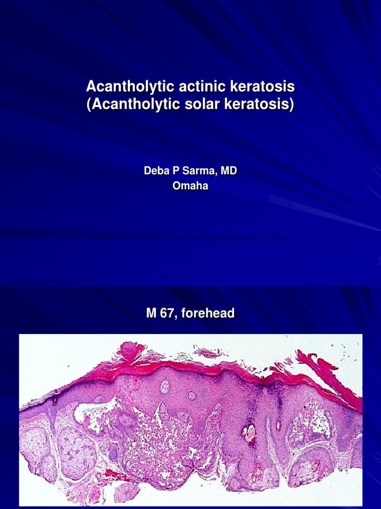 Actinic Keratosis, Acantholytic Type. M 67, Forehead | PDF | Sensory ...