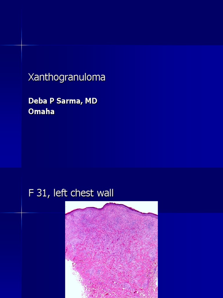 Xanthogranuloma: Deba P Sarma, MD Omaha | PDF