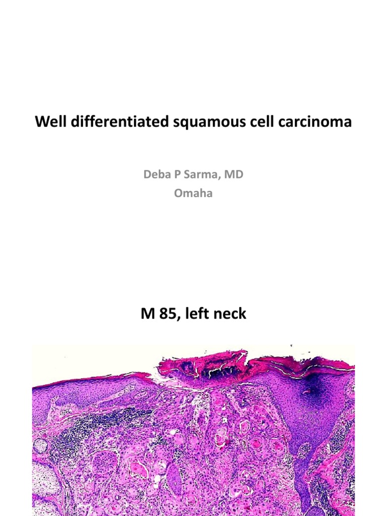 Well Differentiated Squamous Cell Carcinoma | PDF