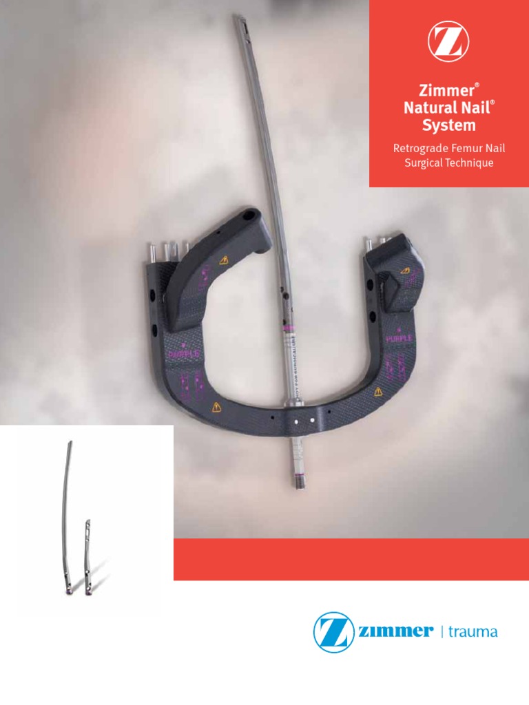 ZNN Retrograde Nail | PDF | Screw | Hip