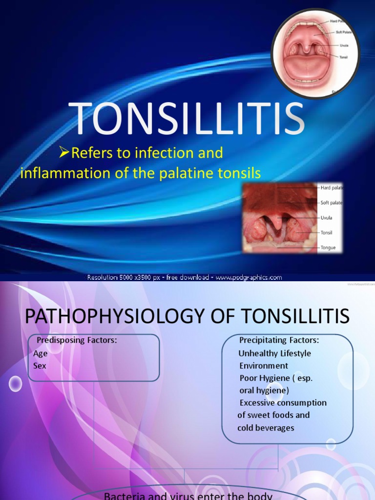 Tonsillitis