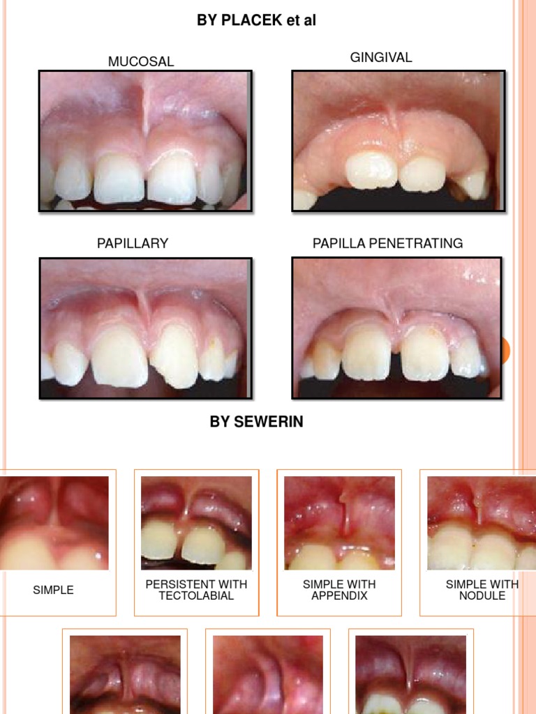 FRENECTOMY | PDF