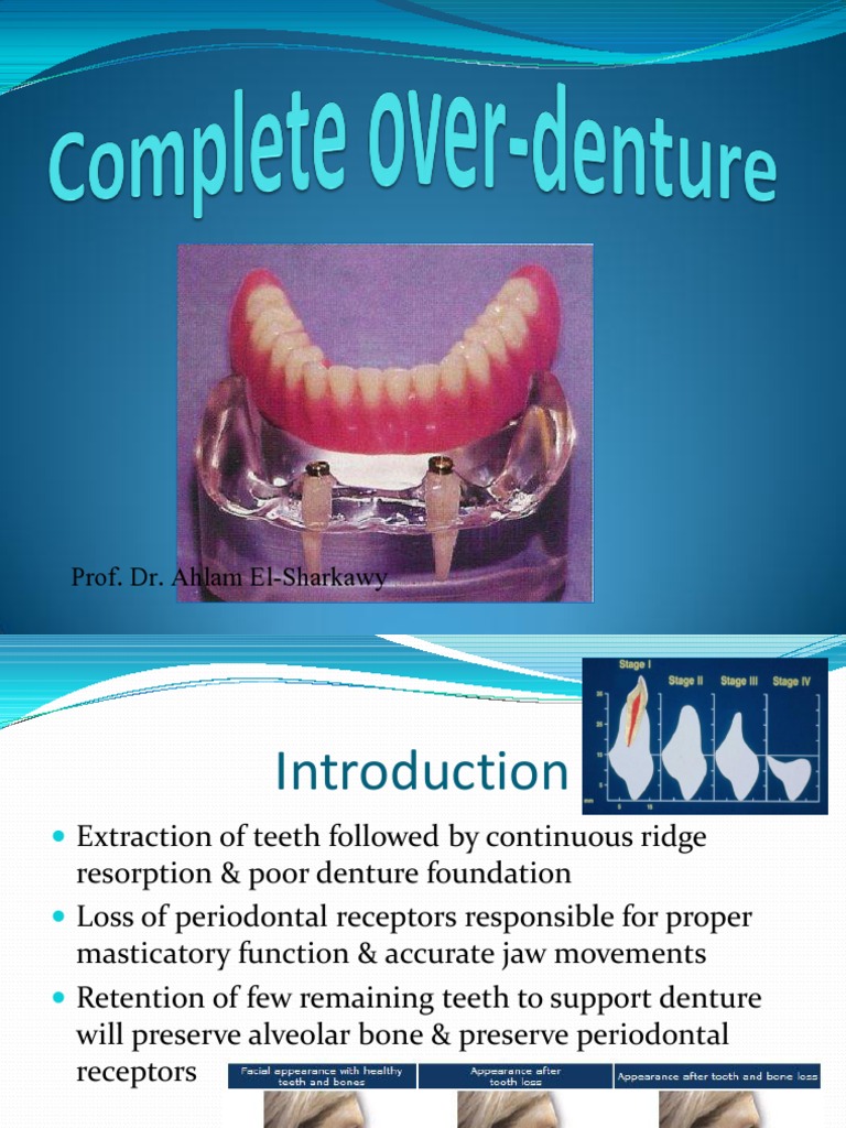 Overdenture | PDF