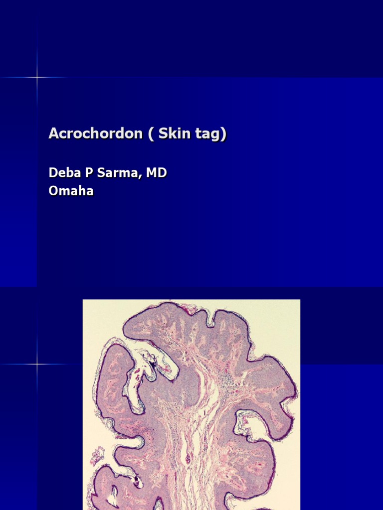 Acrochordon (Skin Tag) - PPT DS | PDF