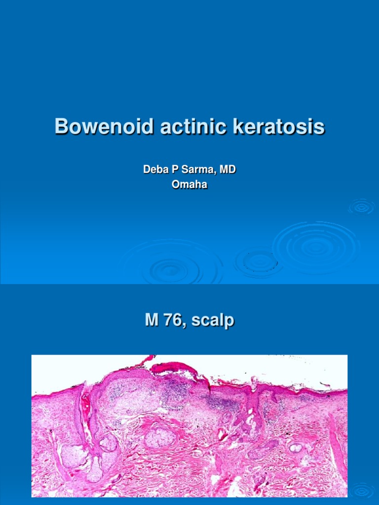 Bowenoid Actinic Keratosis Overview | PDF