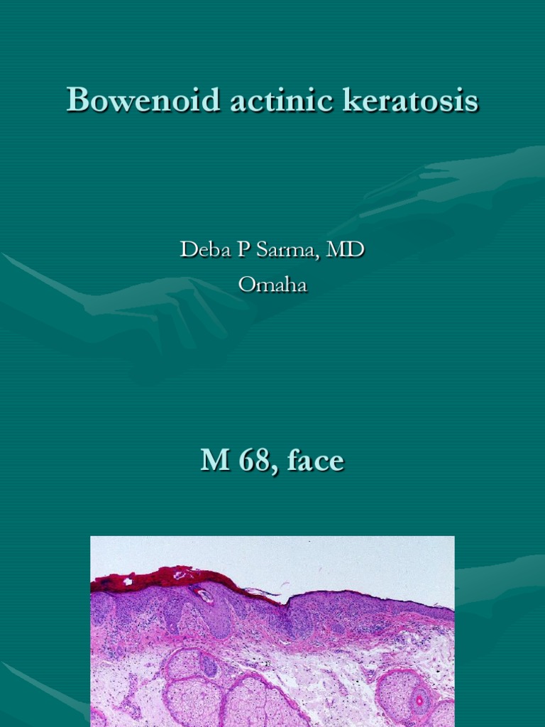 Bowenoid Actinic Keratosis Overview | PDF