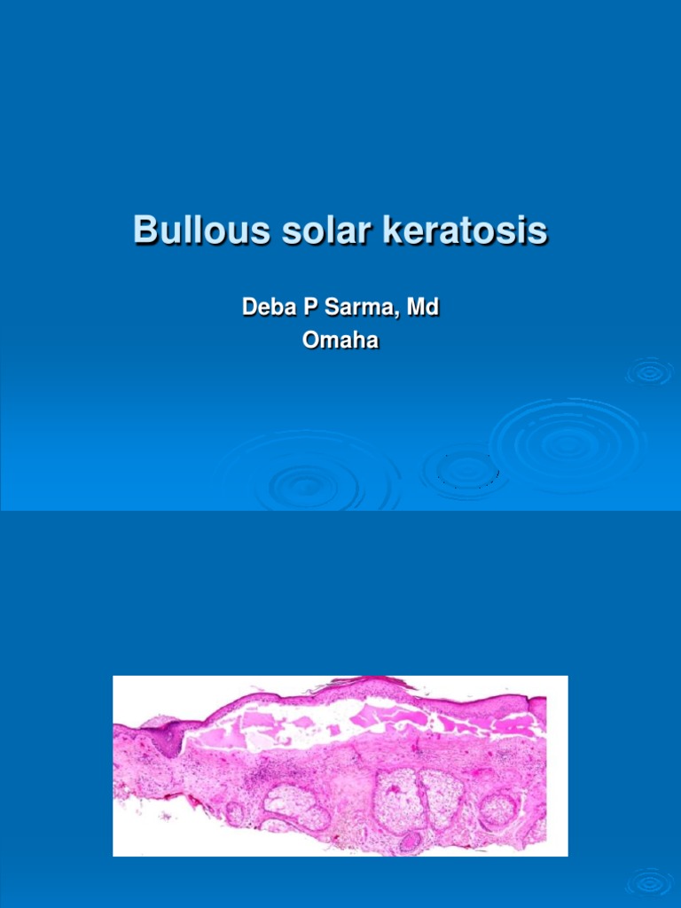 Bullous Disease of The Skin, Bullous Solar Keratosis | PDF