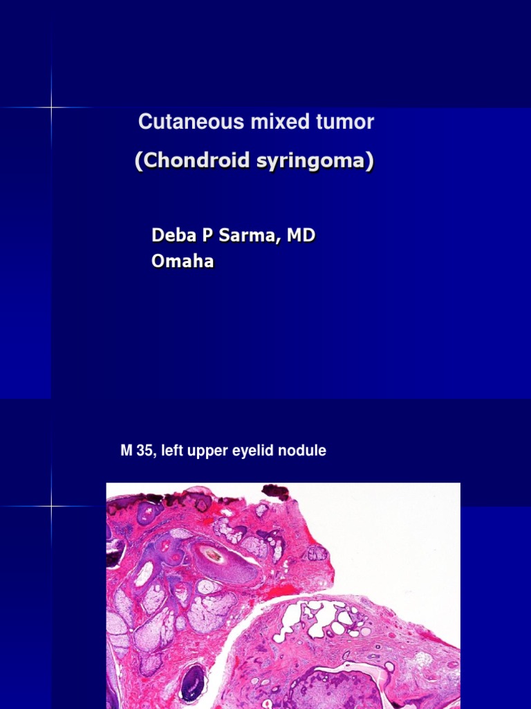 Chondroid Syringoma (Cutaneous Mixed Tumor) | PDF