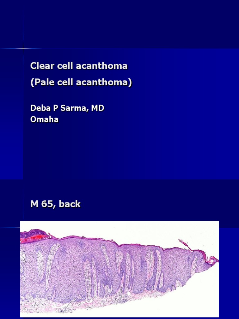 Clear Cell Acanthoma Overview | PDF