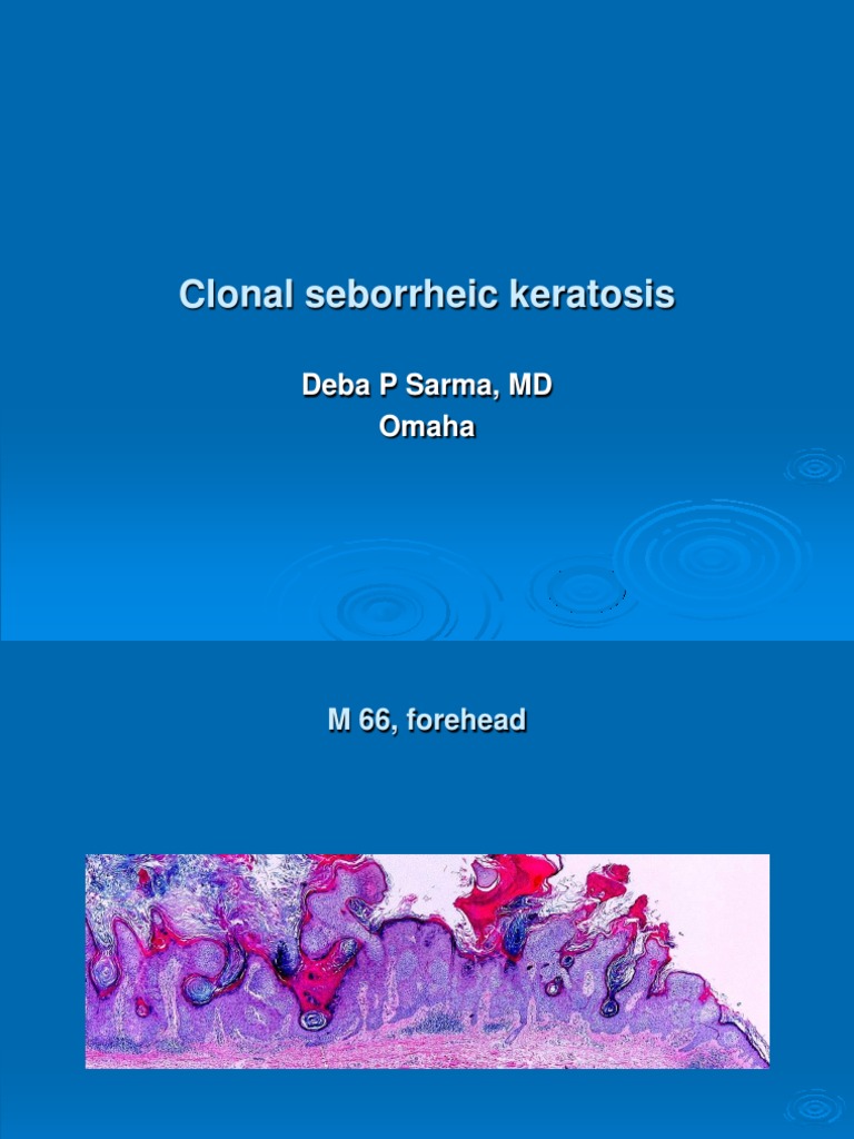 Clonal Seborrheic Keratosis, M 66, Forehead | PDF