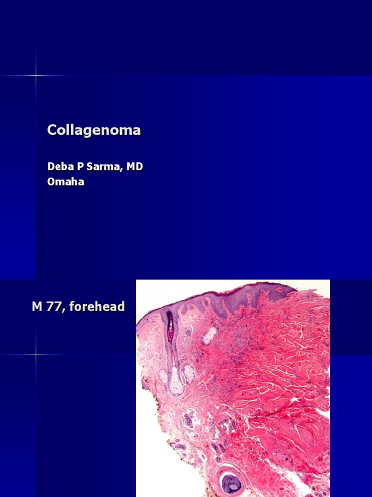 Understanding Collagenoma: Diagnosis & Features | PDF