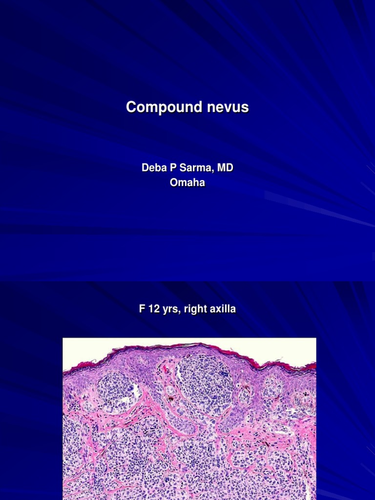Compound Nevus. F 12 Yrs, RGHT Axilla | PDF