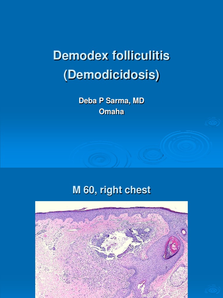 Demodex Folliculitis Case Study | PDF | Medical Specialties | Diseases ...