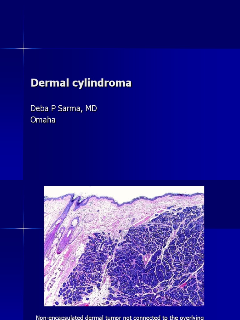Dermal Cylindroma | PDF | Neoplasms | Clinical Medicine