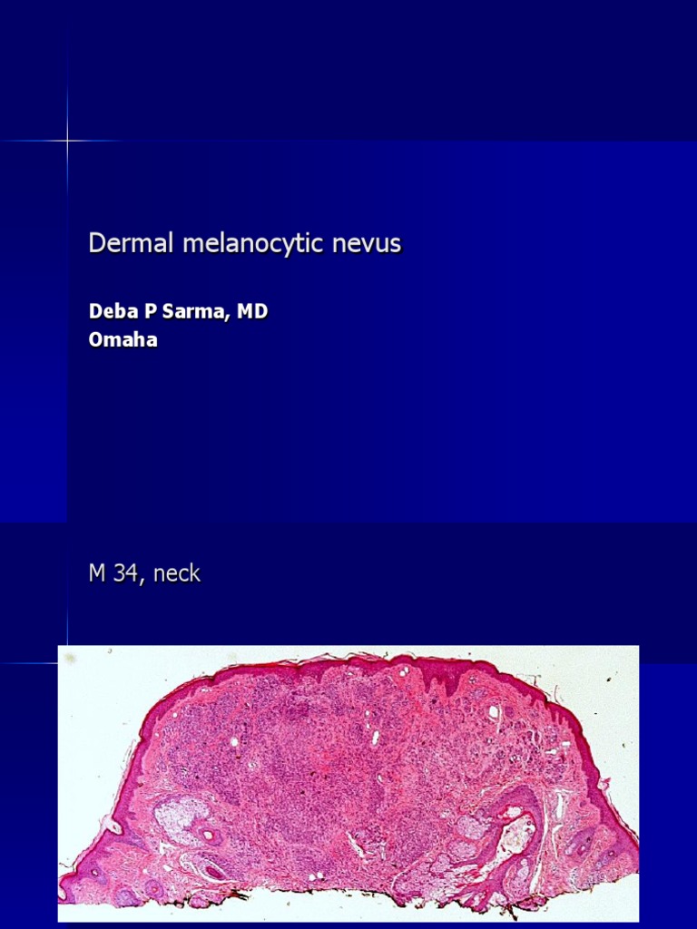 Dermal Melanocytic Nevus, M 34, Neck | PDF