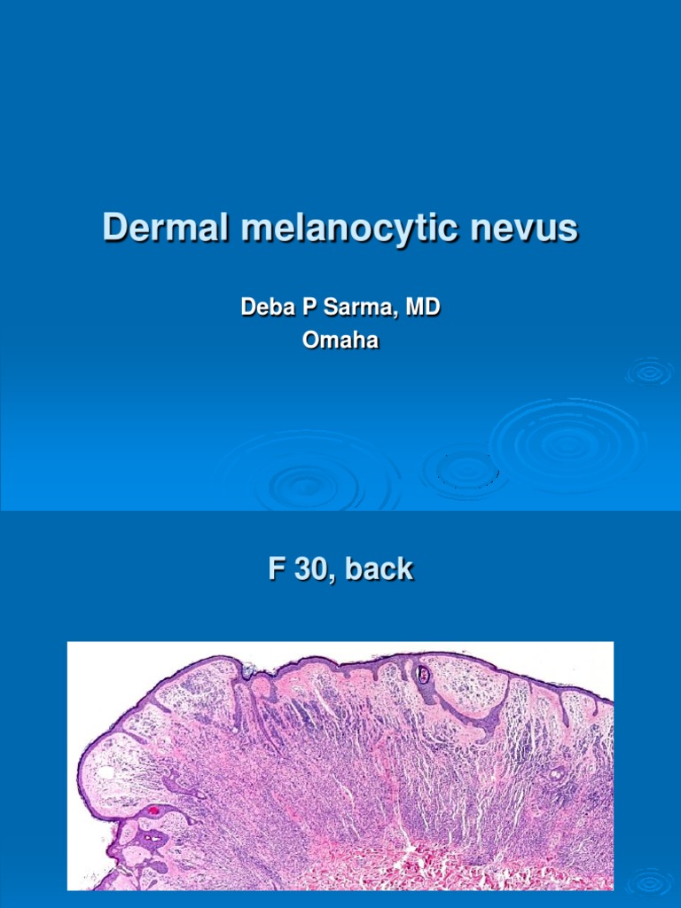 Dermal Melanocytic Nevus Overview | PDF