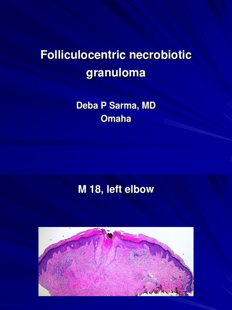 Folliculocentric Necrobiotic Granuloma Case | PDF