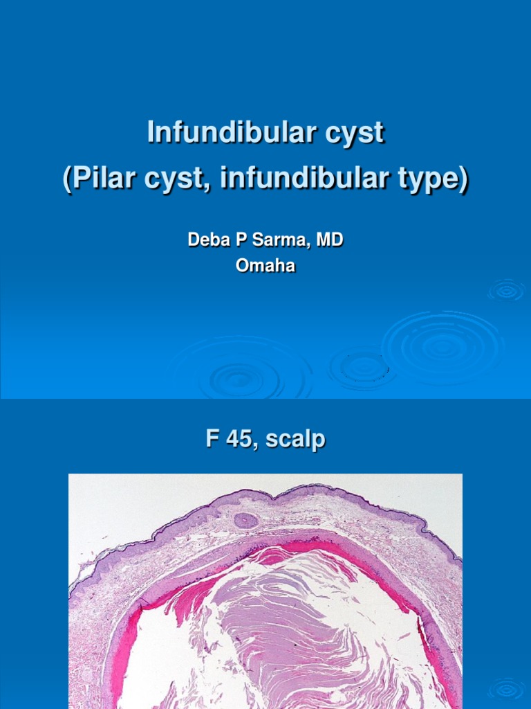 Infundibular Cyst Overview and Case Study | PDF