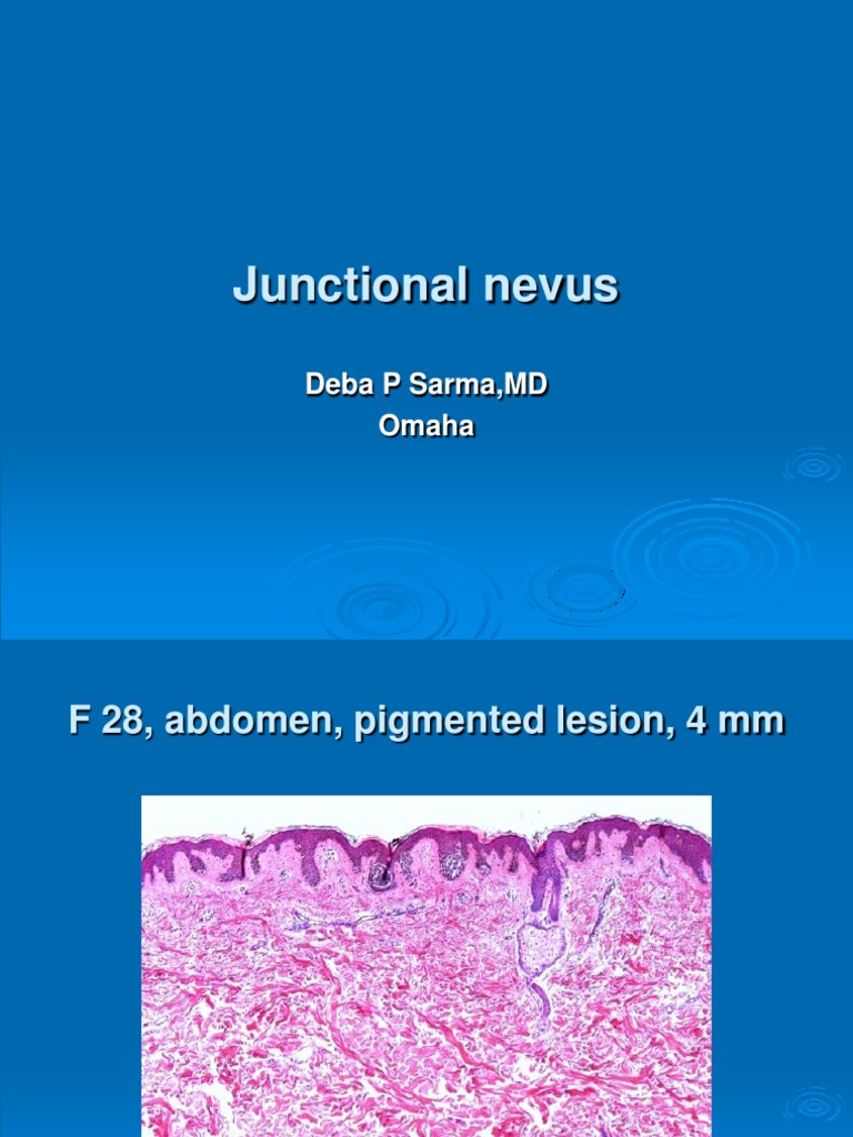 Junctional Nevus. F 28, Abdomen | PDF