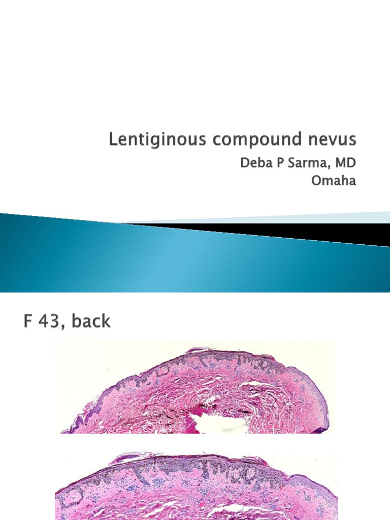 Lentiginous Compound Nevus.F 41, Back | PDF