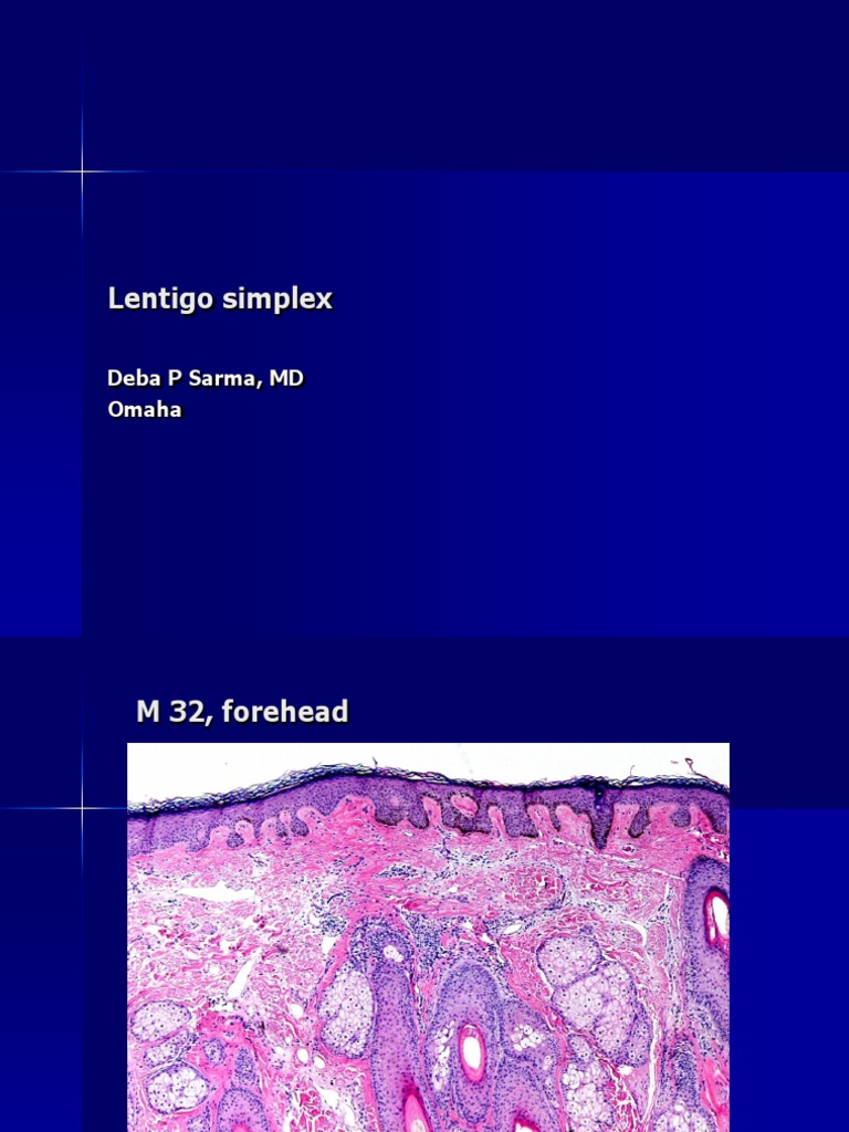 Lentigo Simplex, M 32, Forehead. | PDF | Cutaneous Conditions | Dermatology