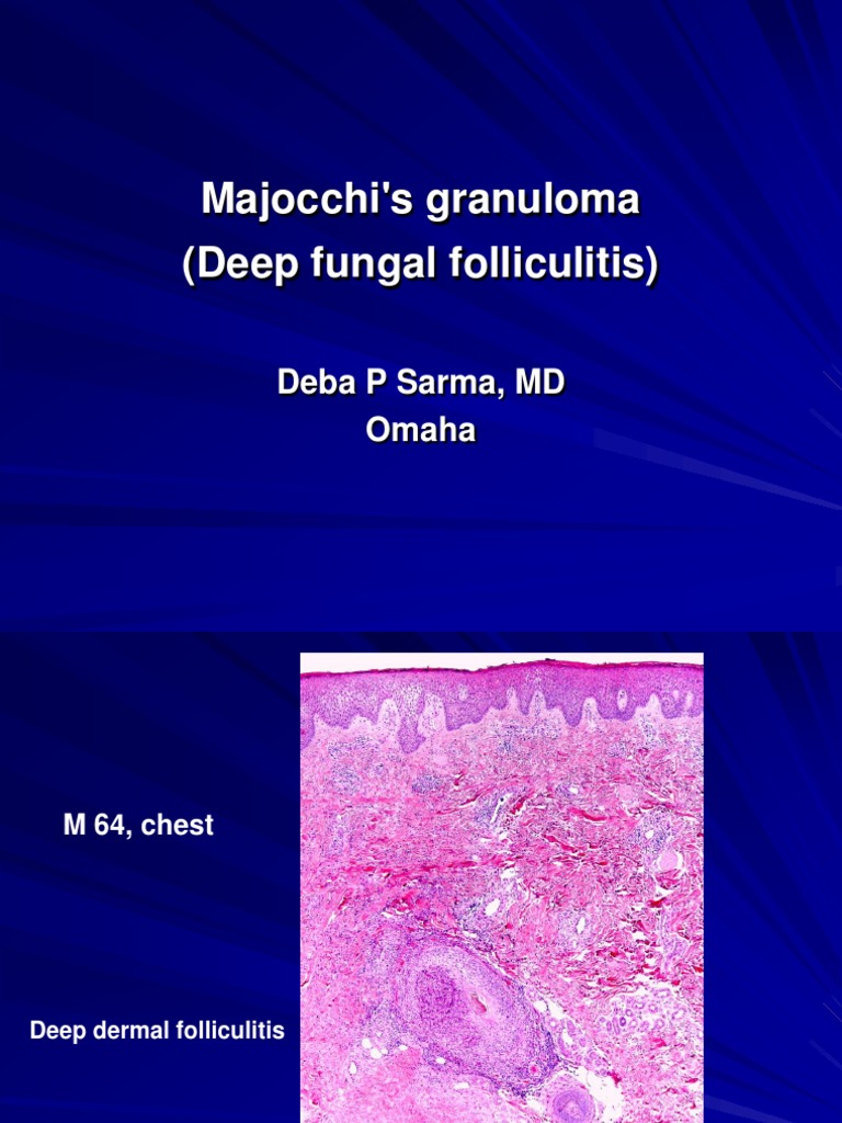 Majocchi's Granuloma, M 64, Chest | PDF | Social Science