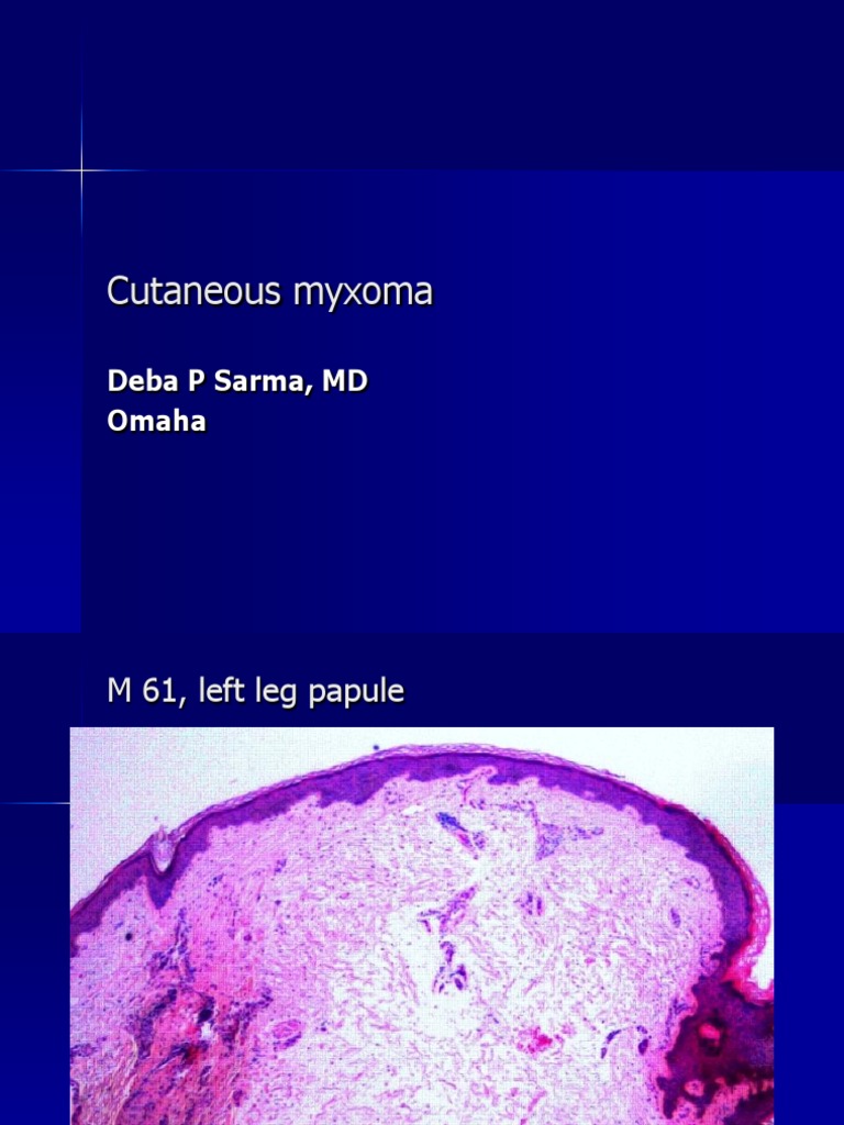 Myxoma Cutis., M 61, Left Leg Papule | PDF
