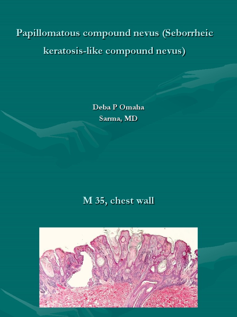 Papillomatous Compound Nevus (Seborrheic Keratosis-Like Compound Nevus ...