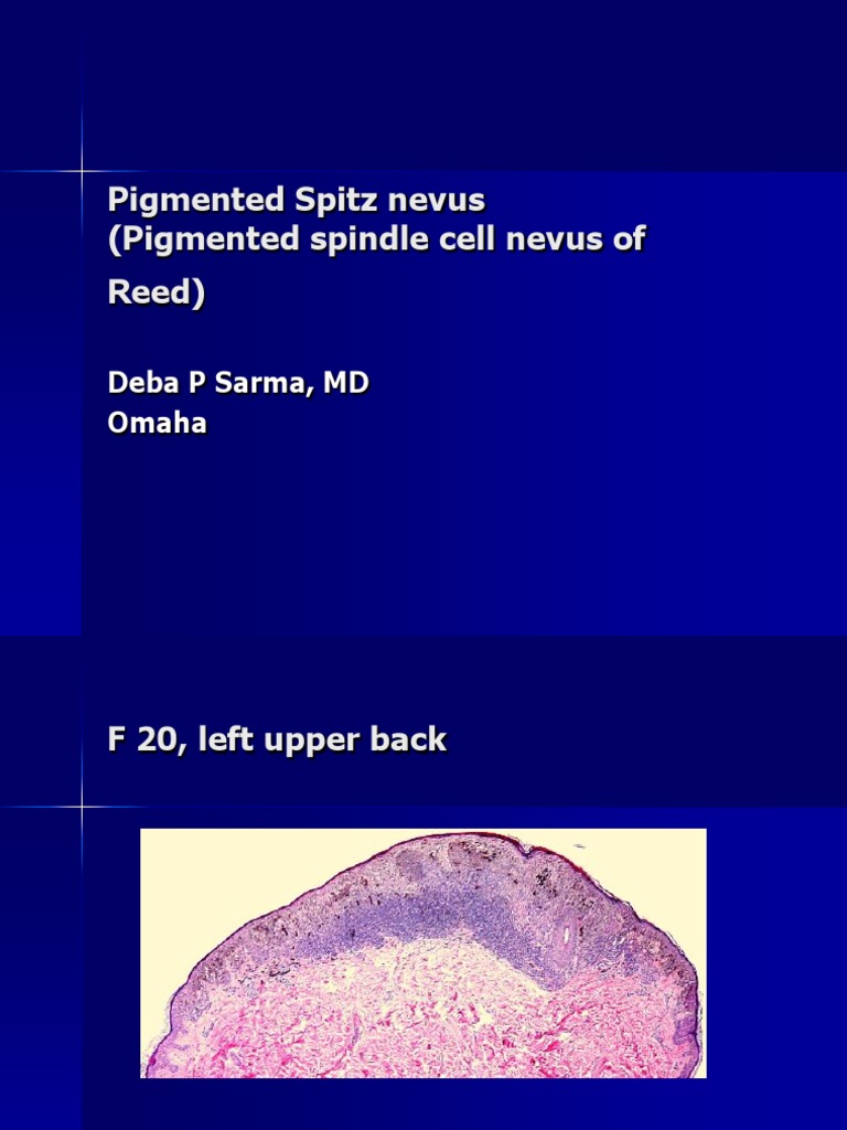 Pigmented Spindle Cell Nevus of Reed, F 20, Back | PDF
