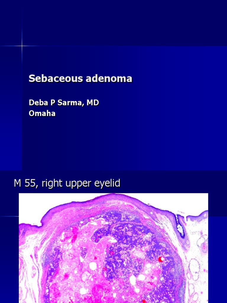 Sebaceous Adenoma, M 55, Right Upper Eyelid | PDF