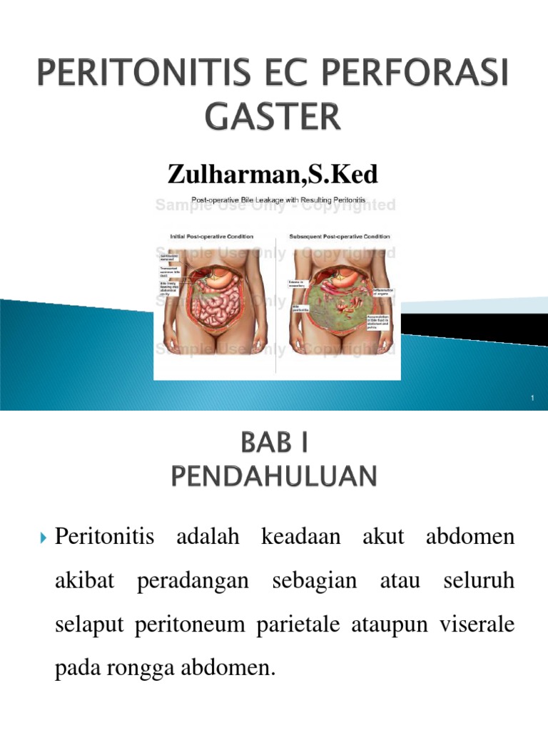 Perforasi Gaster