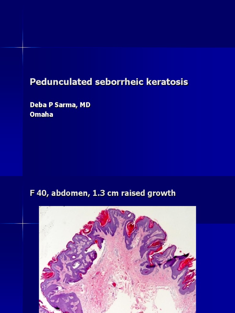 Seborrheic Keratosis, Pedunculated Type, F 40, Abdomen. | PDF