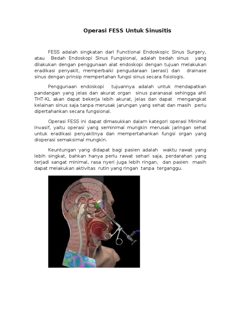 Operasi FESS Untuk Sinusitis | PDF