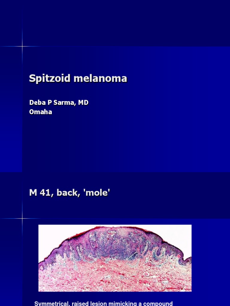 Spitzoid Melanoma, M 41, Back | PDF