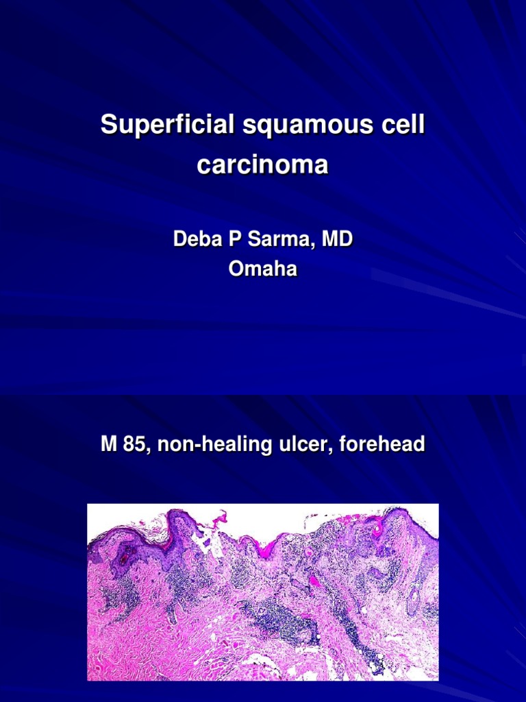 Squamous Cell Carcinoma.,Superficial, M 85, Forehead | PDF