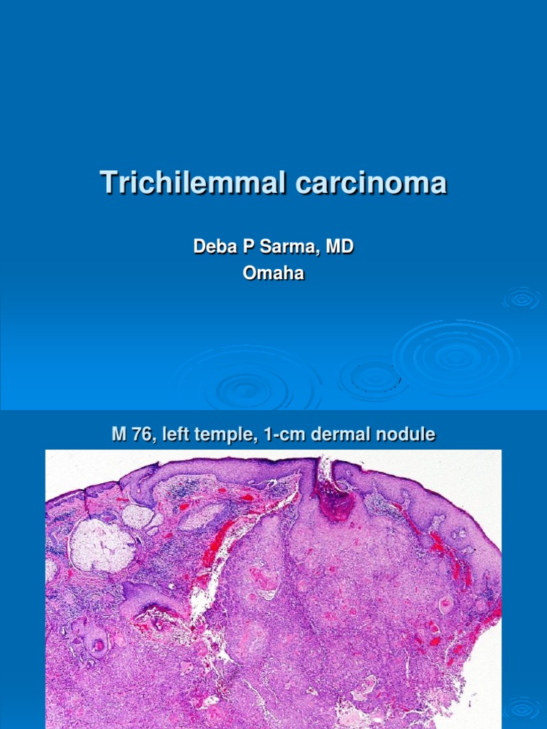 Trichilemmal Carcinoma | PDF