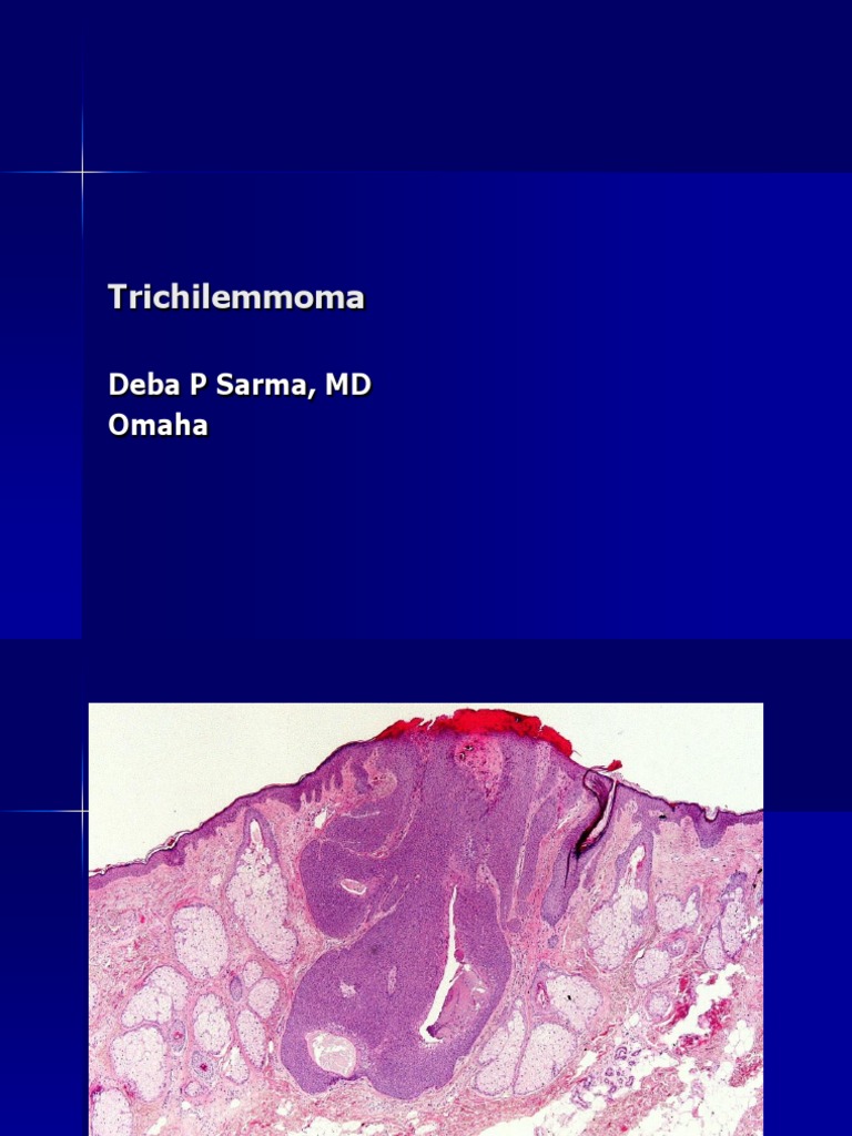 Trichilemmoma Overview and Features | PDF
